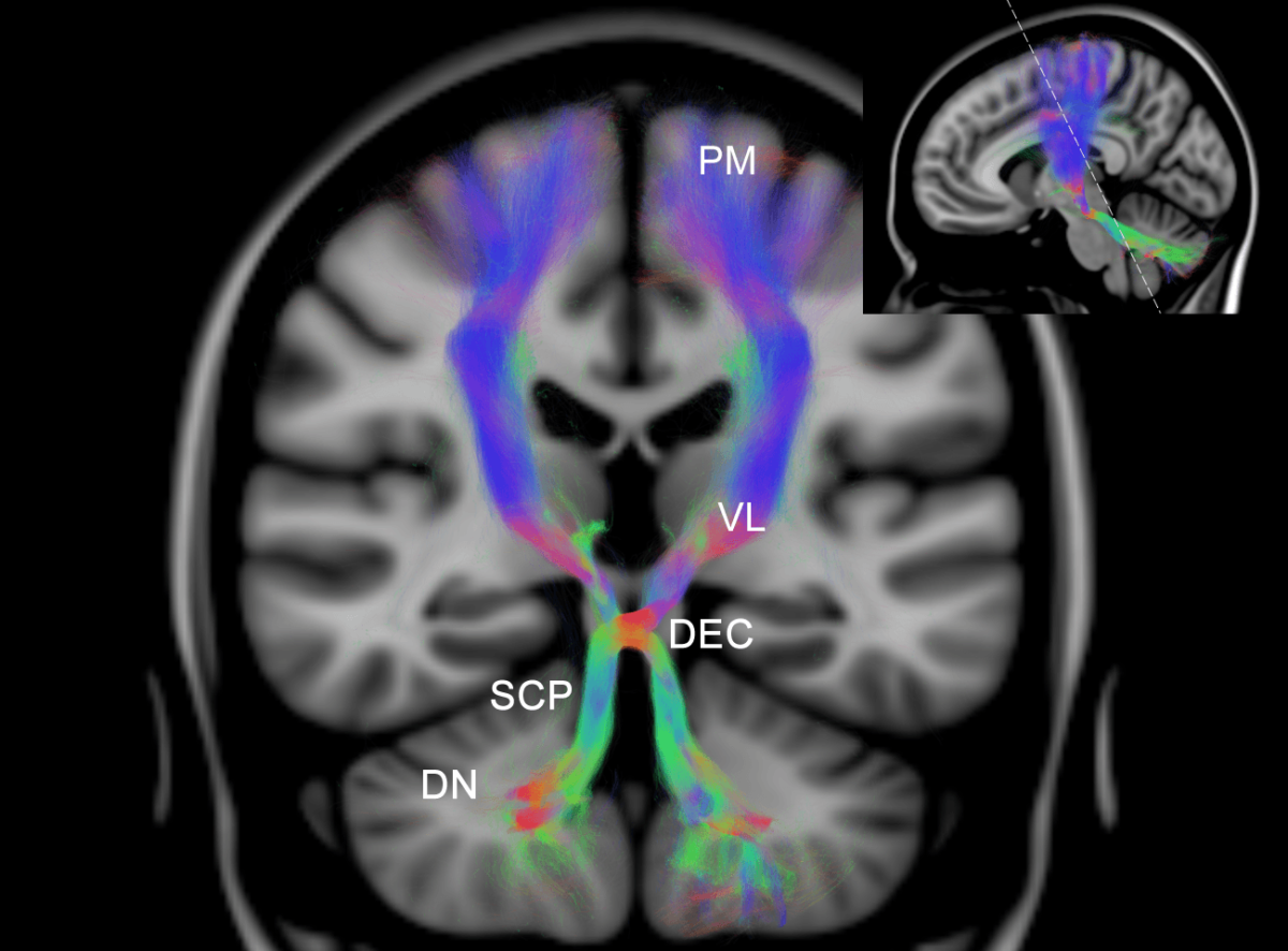 Cerebellar mutism - Neurochirurgisch Centrum Nijmegen