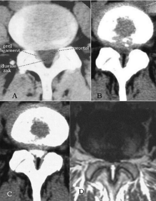 De Lumbale Kanaalstenose - Neurochirurgisch Centrum Nijmegen